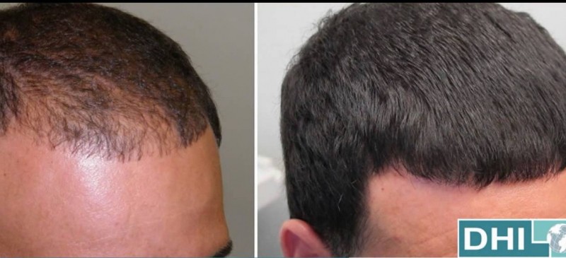 DHI (Direct Hair Implantation) What is DHI Hair Transplant?