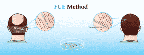 FUE (follicular unit extraction) What is FUE? | Estenbul Health