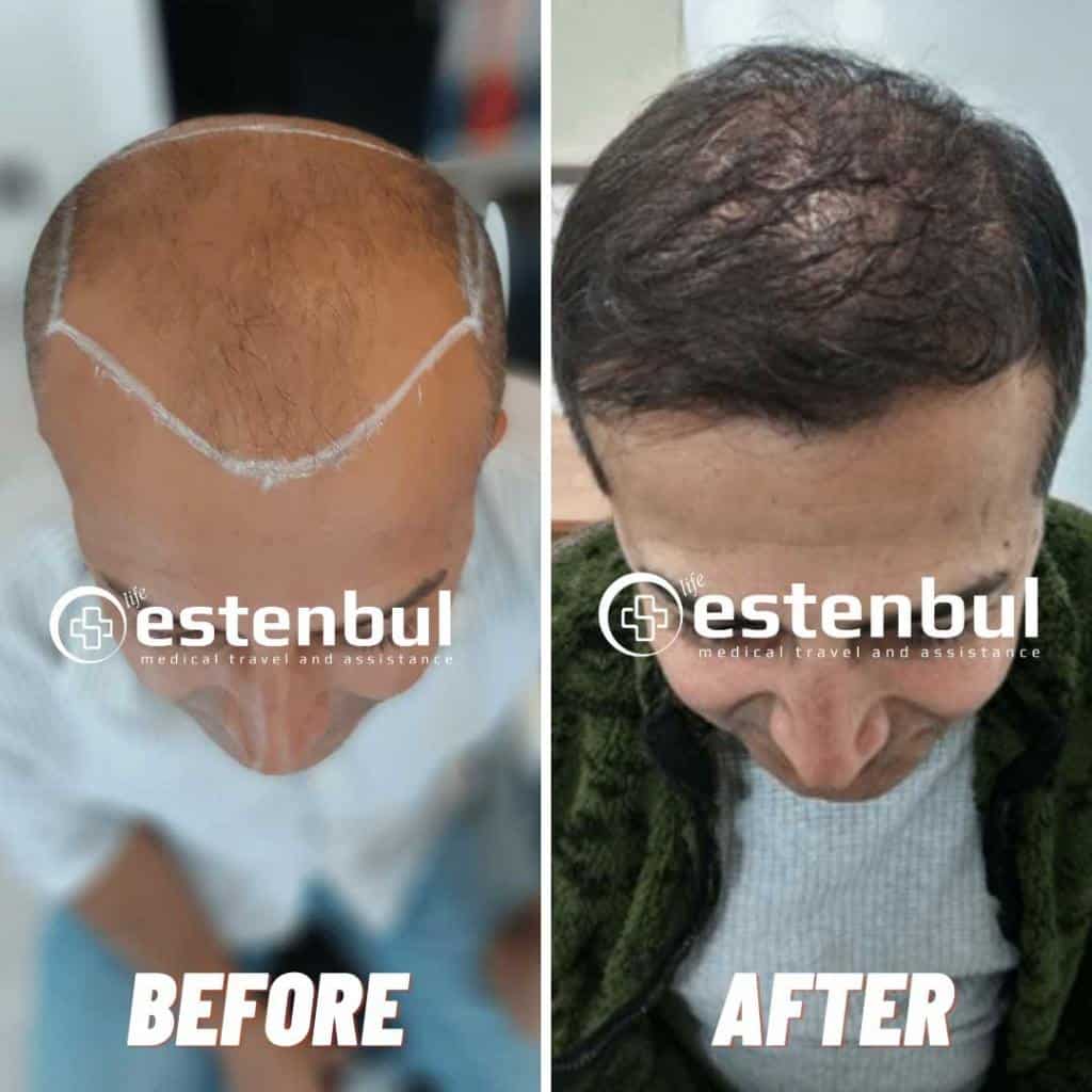Best Hair Transplant in Turkey Istanbul | Estenbul Health