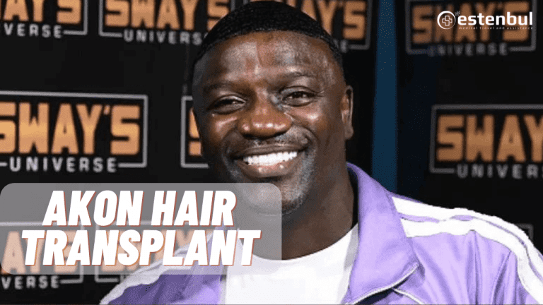 Akon Spent 7,500 Dollars on Hair Transplant in Turkey | Estenbul Health