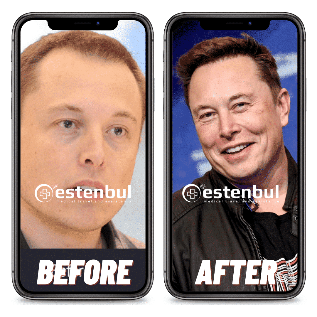 Celebrity Hair Transplant Transformations - Before and After Comparison ...